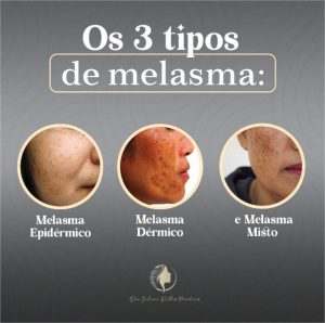 Qual é a causa do melasma? - Dra. Juliana Ruthes Martines